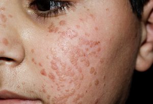 Warts on Face: All Possible Locations, Their Causes, and Effective ...
