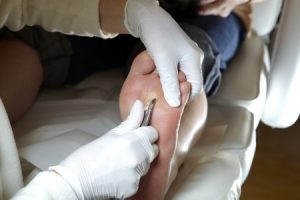 Cutting Off a Wart: Should You Do This or Not? - Med Warts